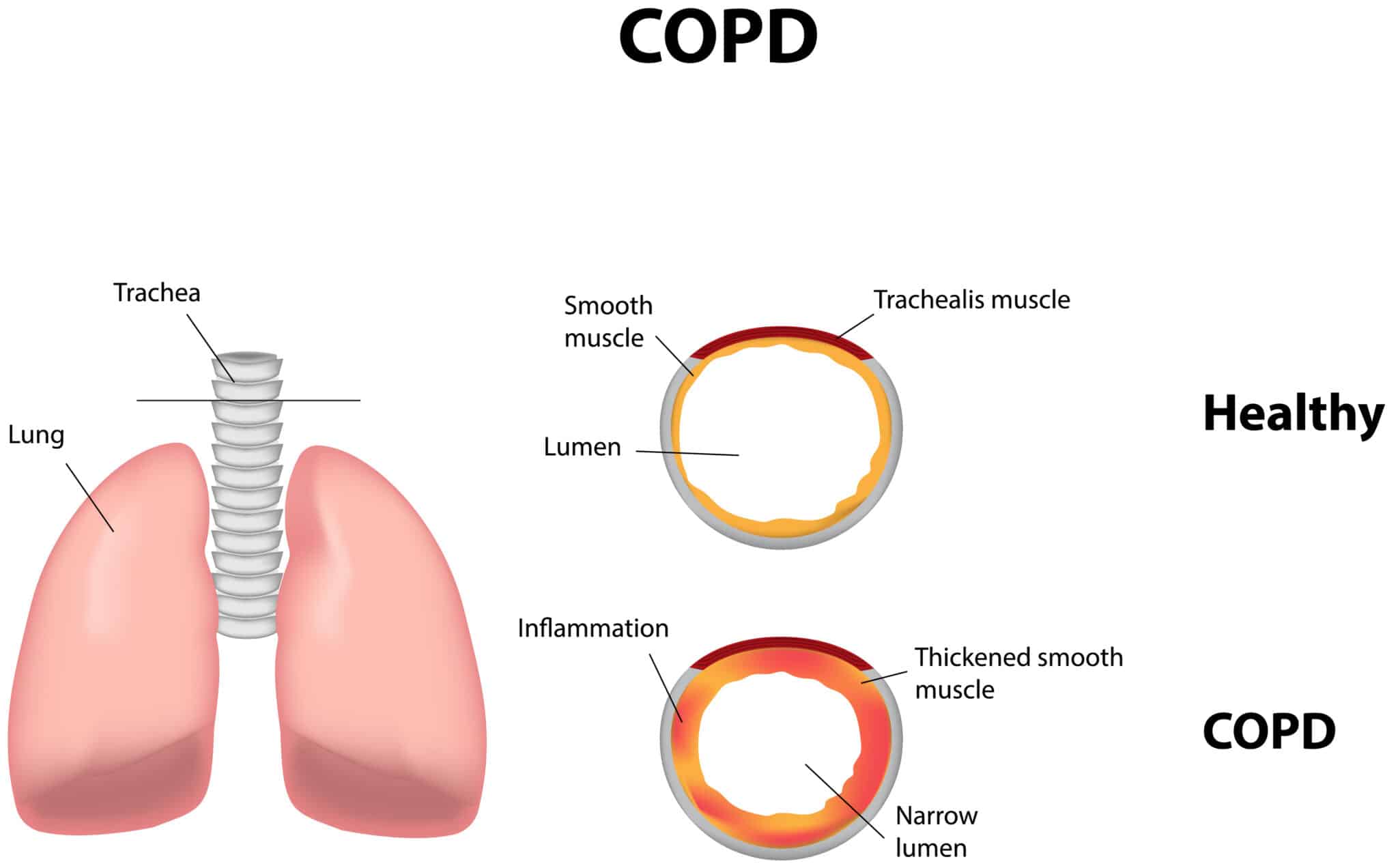 COPD Treatment Lexington | COPD Treatment Thomasville