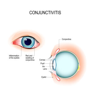 Pink Eye Treatment Lexington | Conjunctivitis Treatment